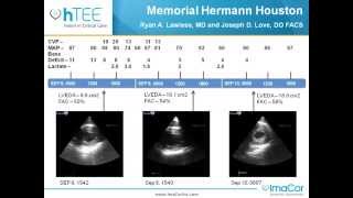 Memorial Hermann Timeline Live: hTEE-Guided Resuscitation of a Patient in Septic Shock