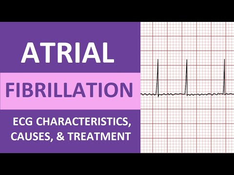 Atrial Fibrillation (A-Fib) Quiz Questions ECG/EKG