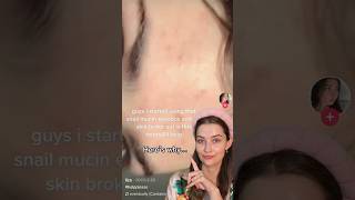 THIS is why snail mucin is breaking you out! ???? #snailmucin