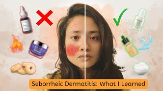 My Struggle with Seborrheic Dermatitis on Face: What Helped Me Heal