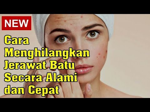 5 Cara Alami Mengobati Jerawat Batu – Resep Sehat