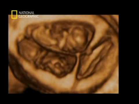 ¿Qué es el cuate de agua o síndrome del gemelo evanescente? – vicentagarciabernal