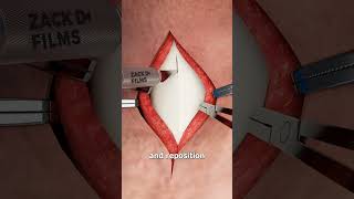 What Happens During A Tracheotomy ????