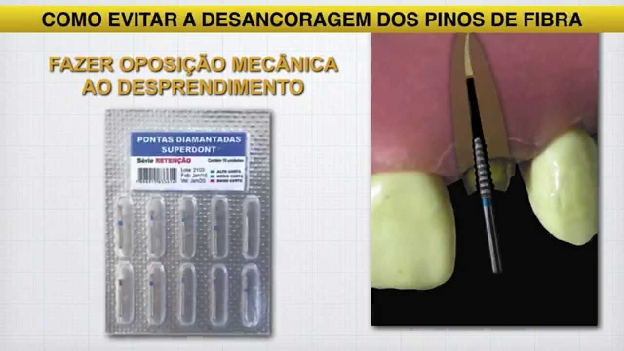 Superfiber Splint – Superdont