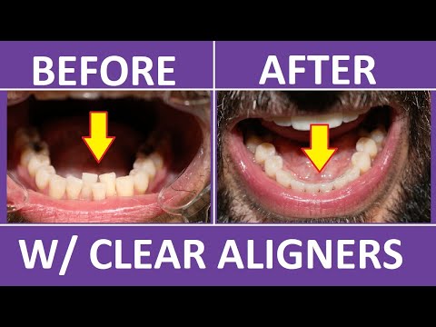 Invisalign (Clear Aligner) Braces Before and After: 3M Clarity