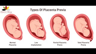 41-year old mom: Complete Placenta Previa resolved in 4 Acupuncture treatments