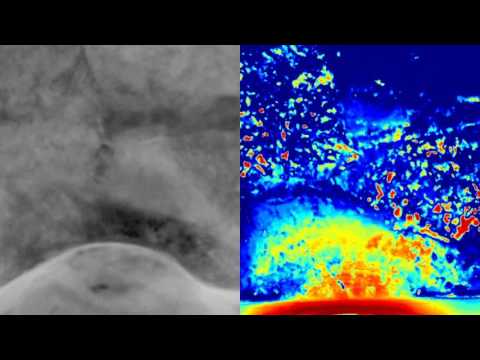Motion detection for TEM in situ indentation – Nuclear Materials at Purdue