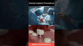 Dental Implant Procedure