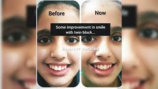 #orthodontic treatment /#braces treatmentnin #hoshiarpur ..Guaranteed result..WhatsApp at 9877461510