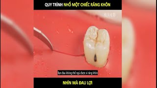 Nhổ một chiếc Răng Khôn đau đến mức nào | LT Review