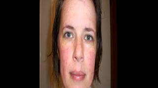 best makeup for rosacea