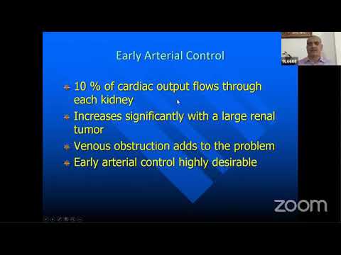 Renal Cell Carcinoma With Thrombus || Urology || Renal Cell Carcinoma ||