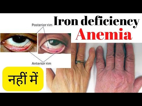 Iron deficiency anemia in Hindi | anemia ki lakshan | anemia symptoms in Hindi | anemia treatment