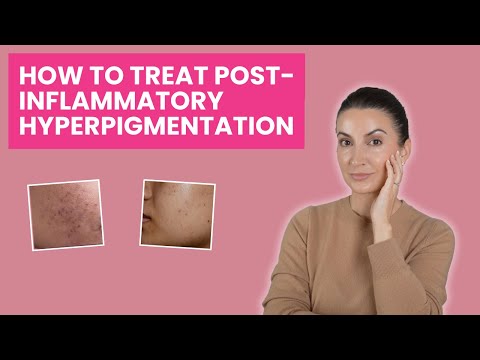 How to Treat Post-Inflammatory Hyperpigmentation | Dermatologist Explains Best Tips & Products