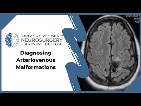 Diagnosing Arteriovenous Malformations