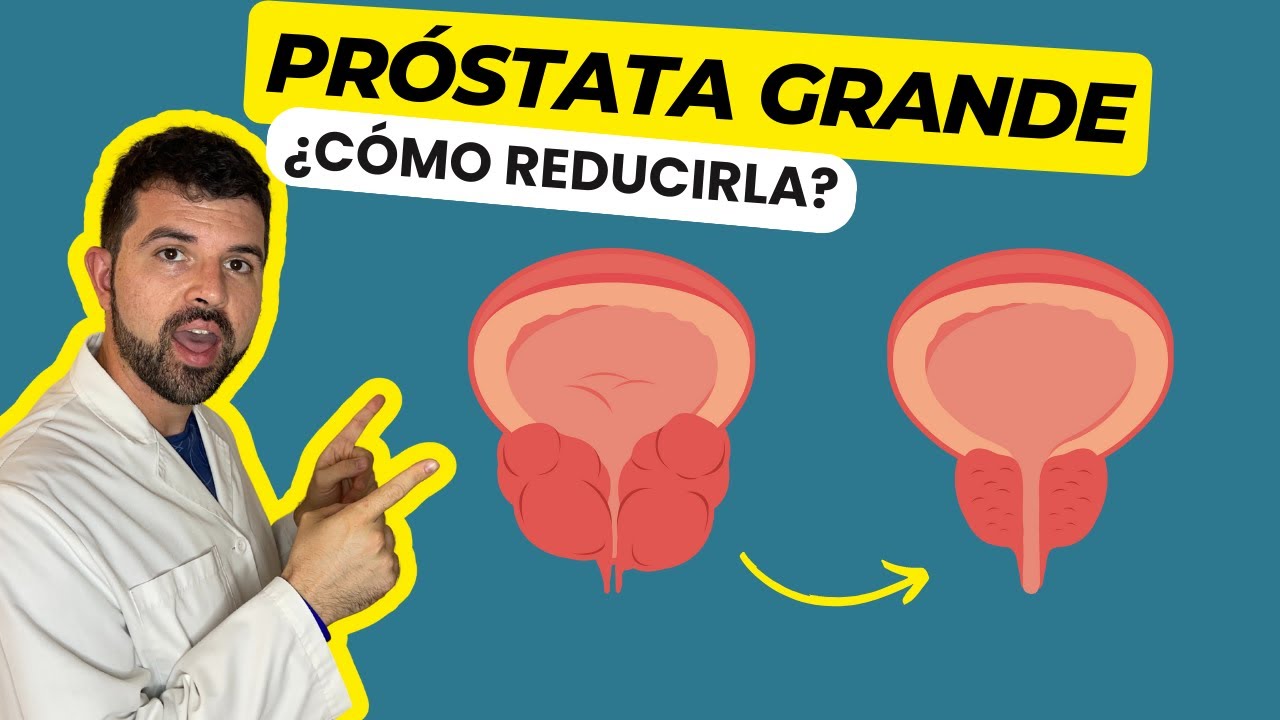 ENLARGED PROSTATE Discover How to Reduce the Prostate