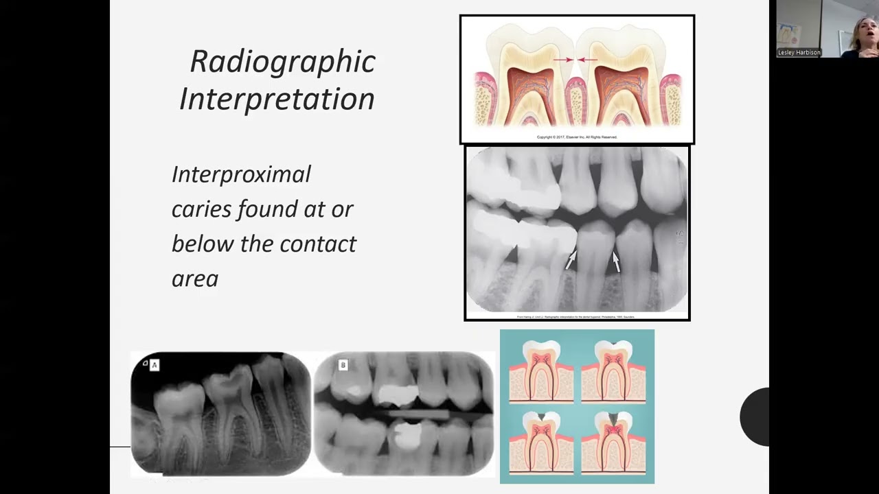 Caries Interpretation and Localization Technique