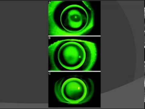 OD Wire Webinar: UltraHealth, The Newest Hybrid Contact Lens