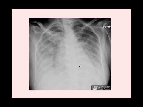 Congestive Heart Failure - CRASH! Medical Review Series