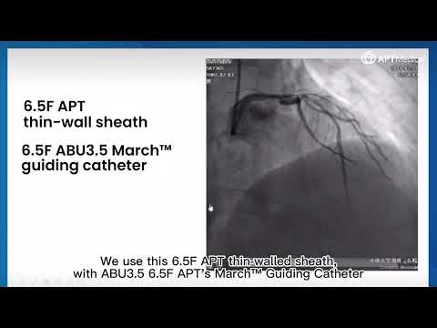 Clinical Cases of 6.5F March™ Guiding Catheter