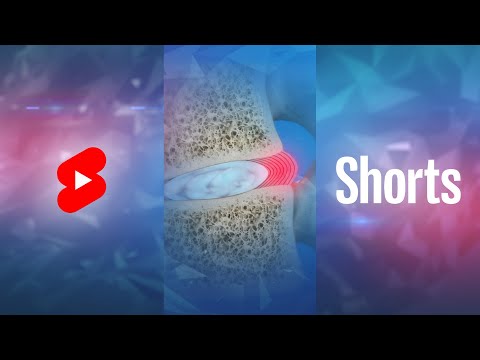 What Is a Bulging Disc? #Shorts