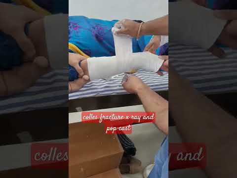 Fracture | Colles fracture x ray and circular pop cast #fracture