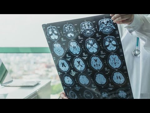 SSM Health Medical Minute: Knowing the signs and symptoms of stroke