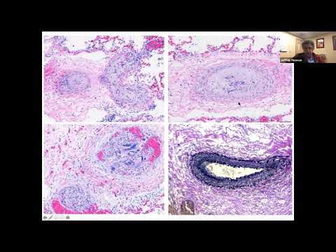 Virtual FTS Pediatric Session: Pulmonary Arterial Hypertension