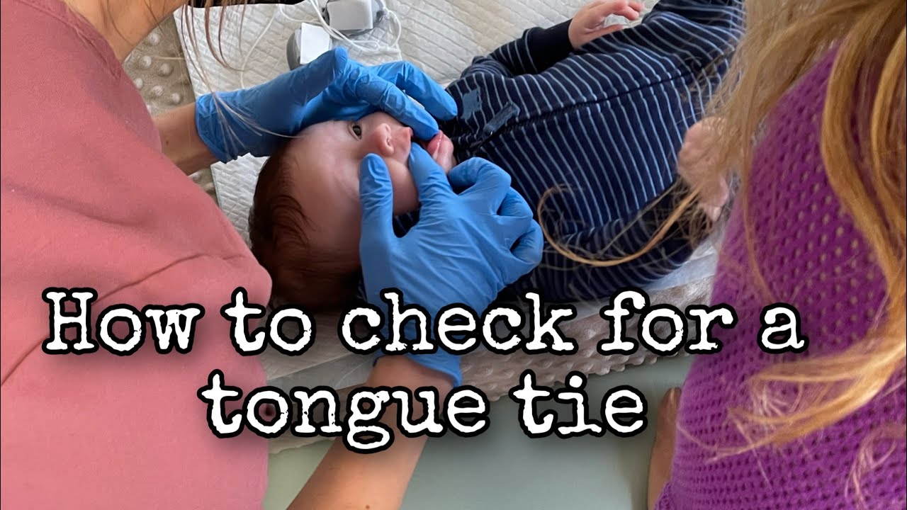 How to check for a tongue tie