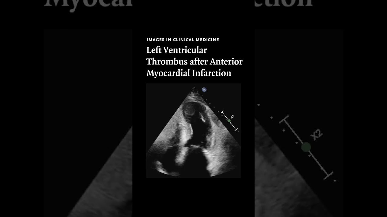 NEJM Images in Clinical Medicine: Left Ventricular Thrombus after Anterior Myocardial Infarction