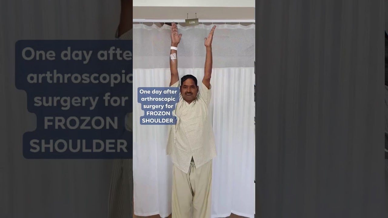 FROZEN SHOULDER : ONE DAY AFTER ARTHROSCOPIC CAPSULAR RELEASE, PAINLESS FULL MOVEMENT