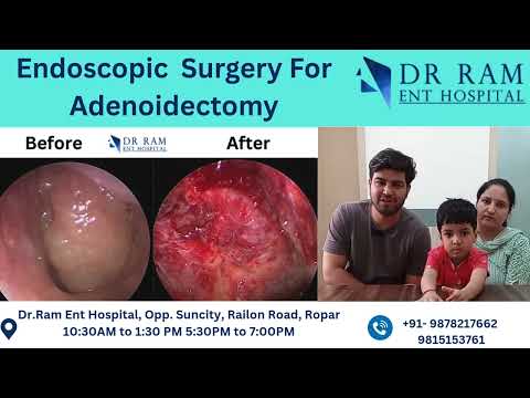 🎥 Endoscopic Surgery for Adenoidectomy at Dr. Ram ENT Hospital, Ropar 🎥