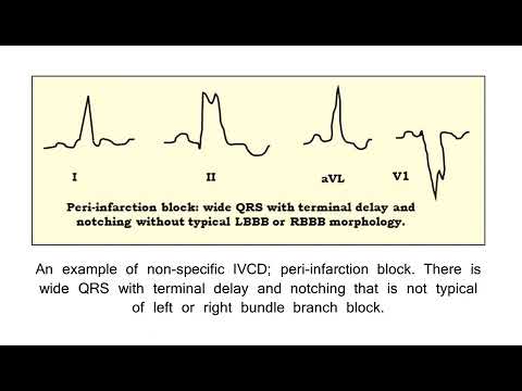 42 Other Intraventricular Conduction Delays