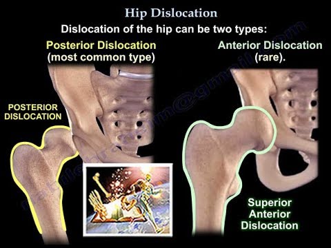 Dislocation of the Hip – Dr. Nabil Ebraheim's Blog