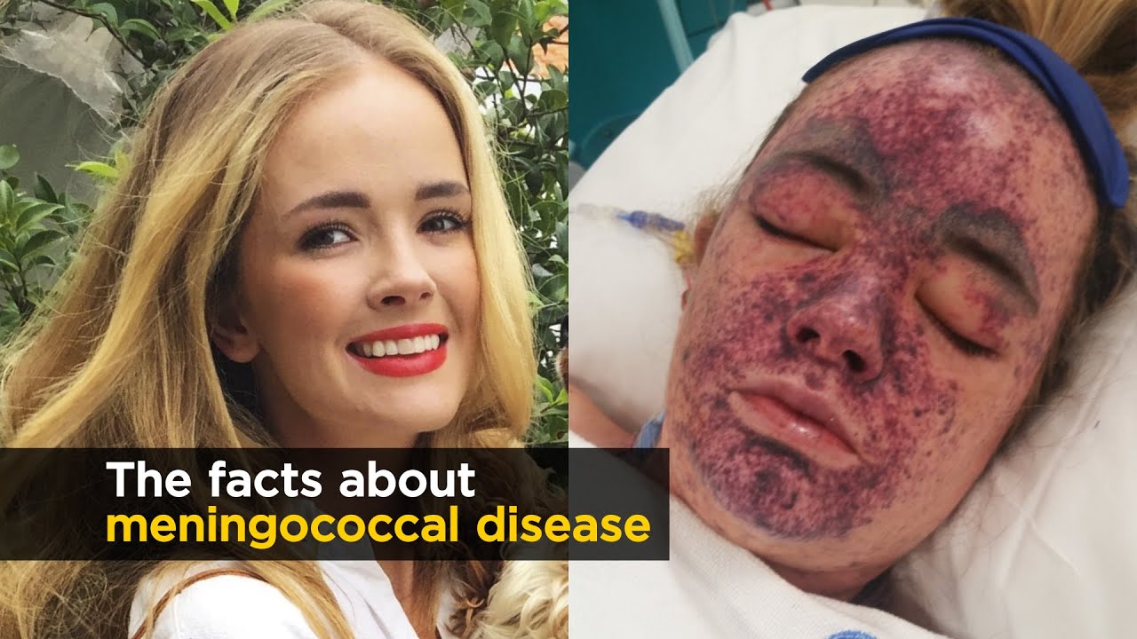 Meningococcal Disease