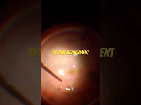 Vitrectomy with silicone band and direct PFC-silicone oil exchange.