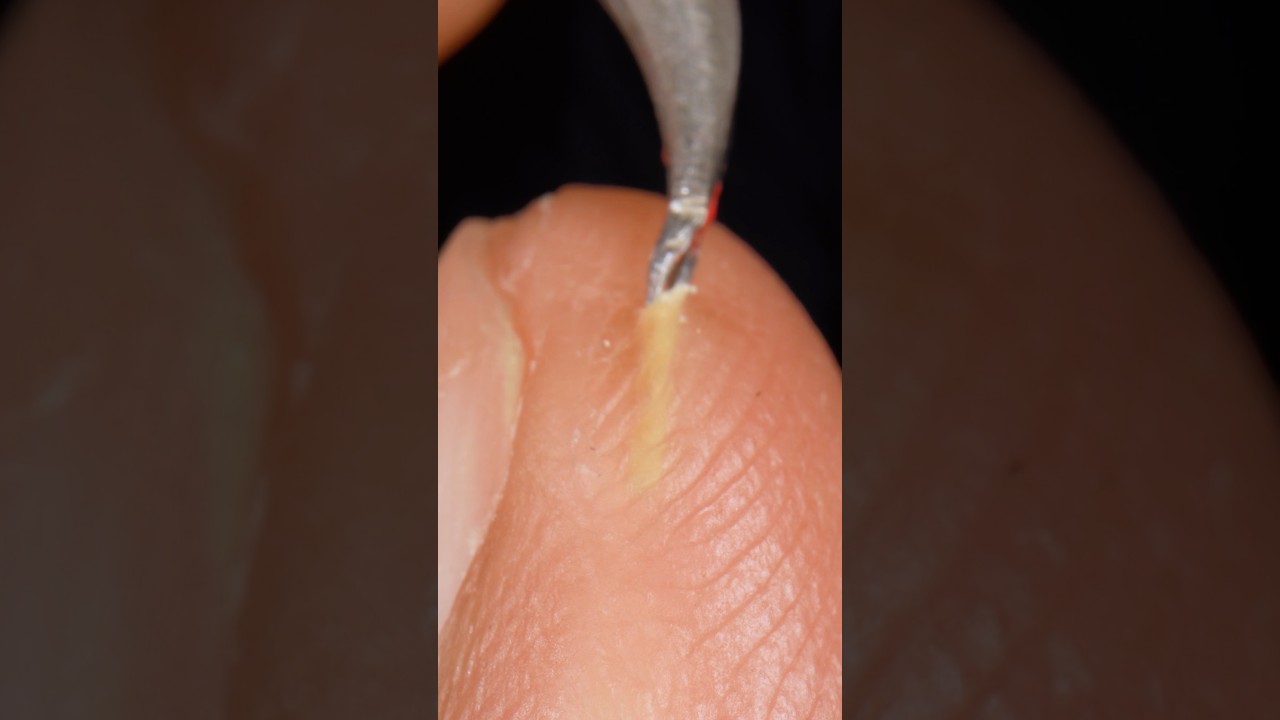 ASMR splinter removal under-skin extraction CLOSE-UP (macro-zoom in) pt2 #asmr #asmrsounds #closeup