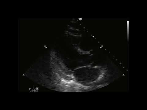How to...Measure LV Fractional Shortening in 2D Mode