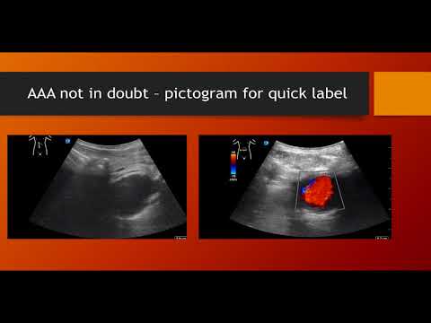 POCUS for AAA | ACUTE GENERAL INTERNAL MEDICINE