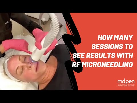 How many sessions to see results with RF MicroNeedling?