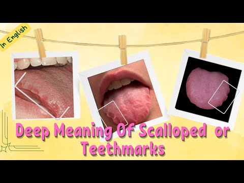 Tongue Tales: Exploring Scalloped Edges and Their Significance.