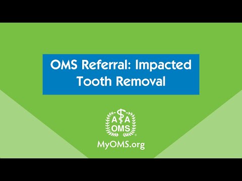 OMS Referral: Impacted Tooth Removal