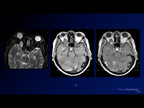 Neuroradiology Board Review - Brain Tumors - Case 19