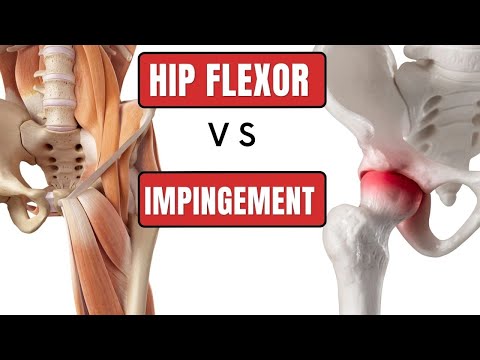 Get the Right Diagnosis: FAI (Impingement) or Hip Flexor Strain?