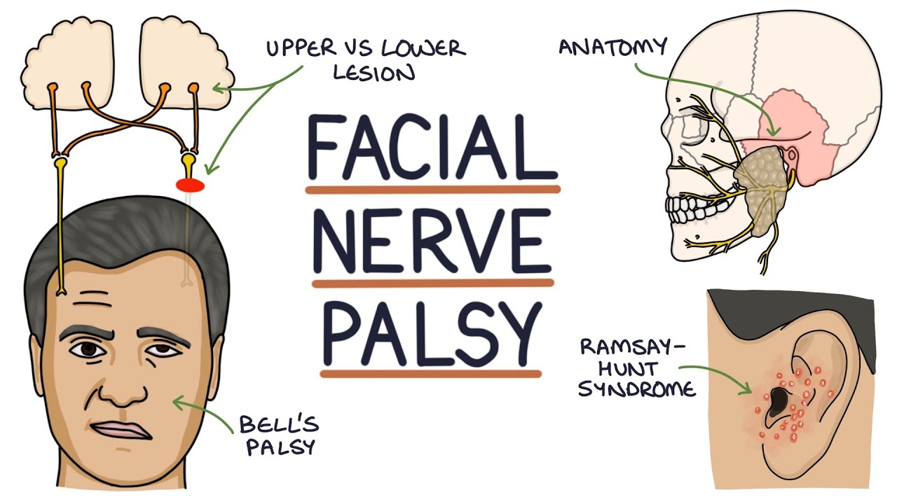 Understanding Facial Nerve Palsy (Facial Weakness)