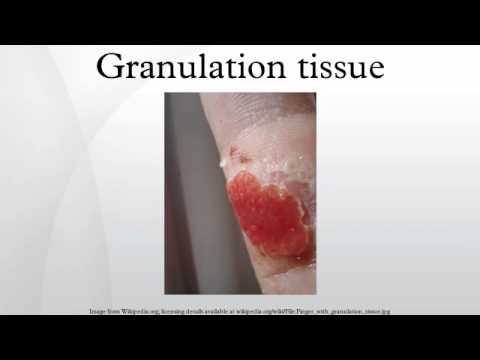 Granulation tissue