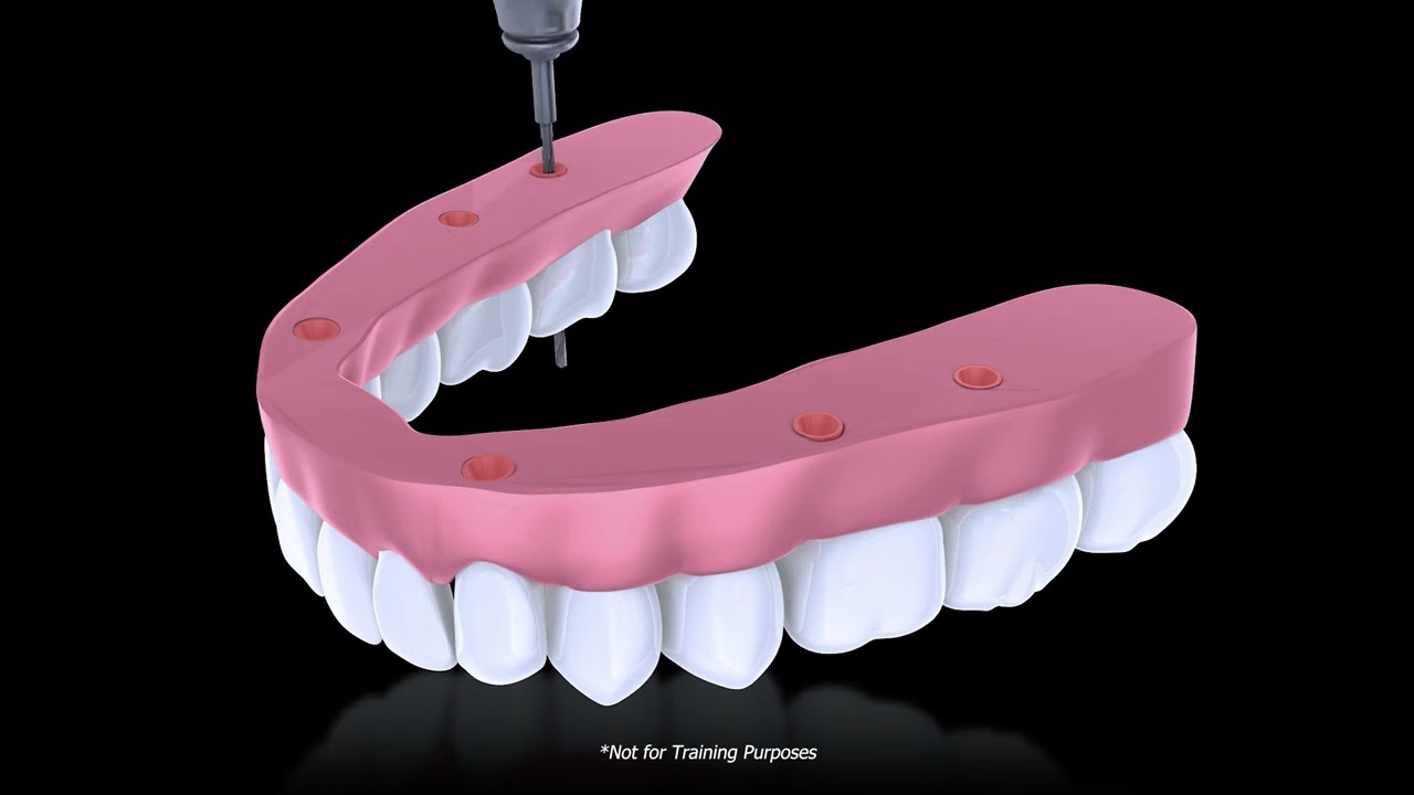 Introducing Smart Denture Conversions