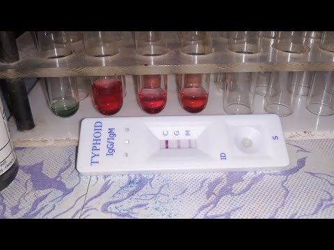 Typhoid Test Kit - Widal Test Kit Latest Price, Manufacturers & Suppliers