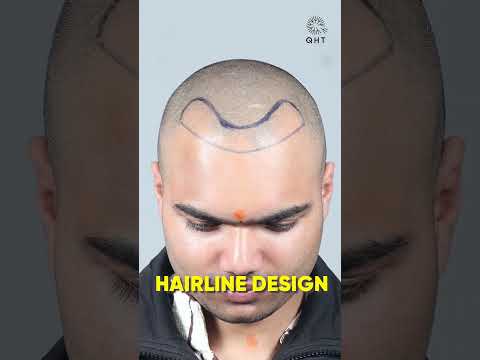 Amazing Hair Transplant Surgery | Latest Fue Technique #shorts #viral #hair transplant