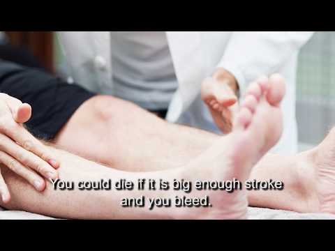 Can You Die From a Stroke?